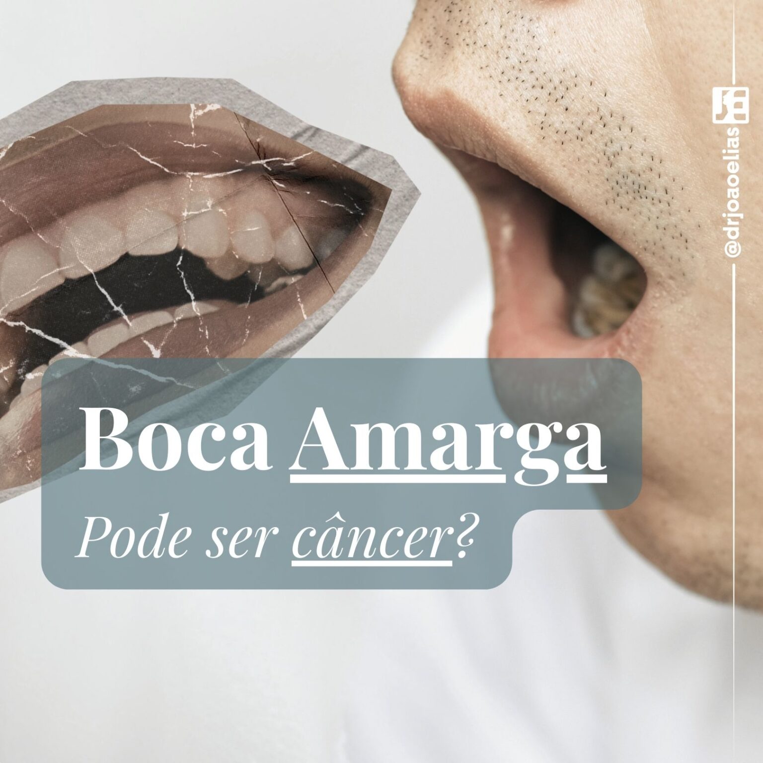 Quais os Sintomas do Câncer de Boca? Os 5 principais! | Dr João Elias