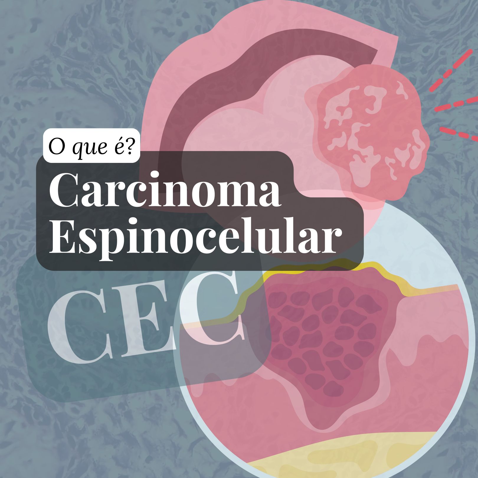 O que é o Carcinoma Espinocelular (CEC) em Cabeça e Pescoço? 7 ...